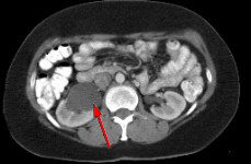AIC News Release Uretero=Pelvic Junction (UPJ) Obstruction