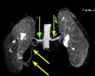 AIC News Release Uretero=Pelvic Junction (UPJ) Obstruction