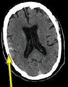 AIC News Release Subarachnoid Hemorrhage (SAH)