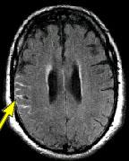 AIC News Release Subarachnoid Hemorrhage (SAH)