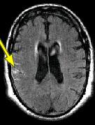 AIC News Release Subarachnoid Hemorrhage (SAH)